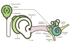 Cochlear implants - RNID